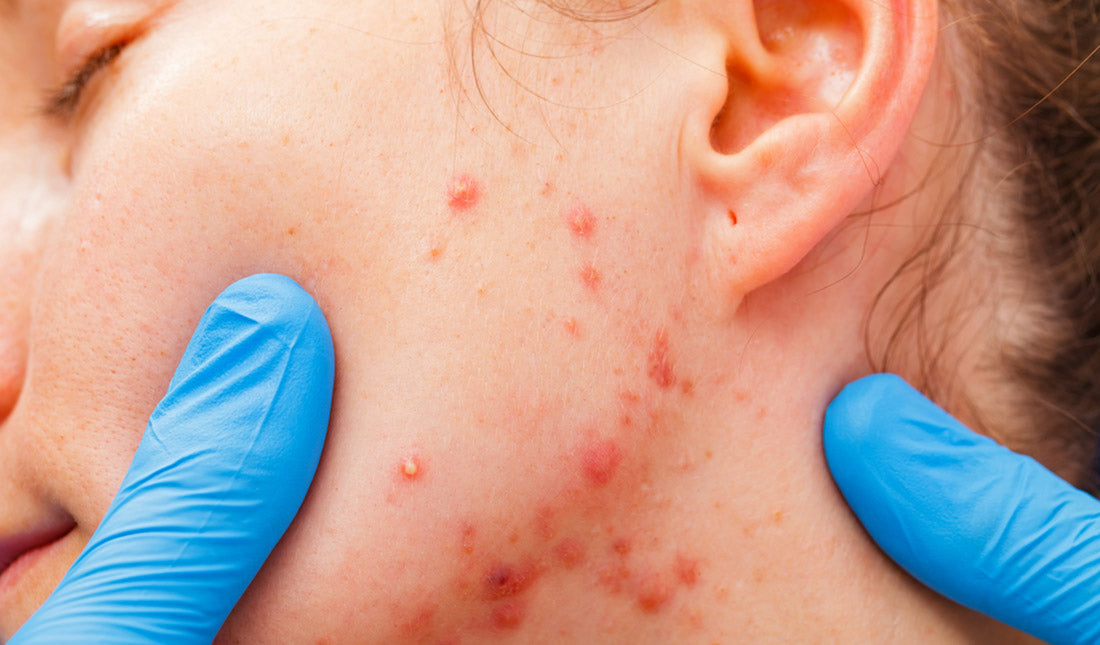 How to Get Rid of Red Pimples – Tiege Hanley