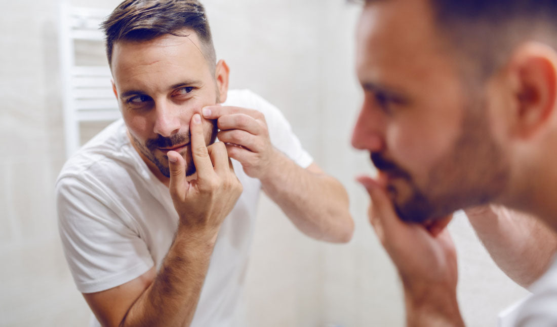 Adult Acne in Men: Causes and How to Treat – Tiege Hanley