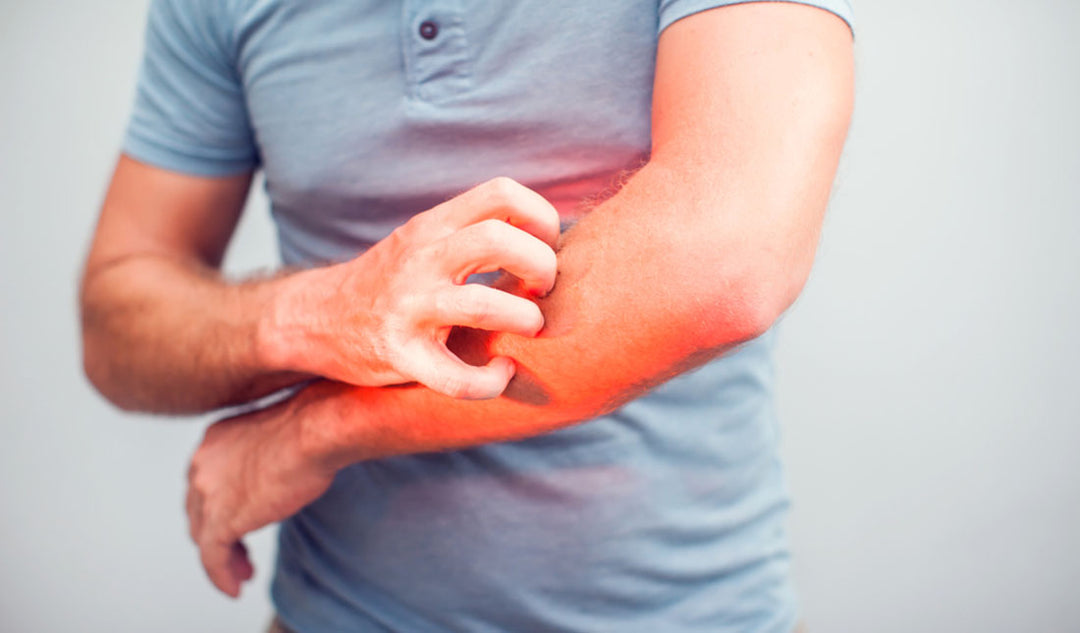 6 Solutions to Stop Sunburn Itch – Tiege Hanley