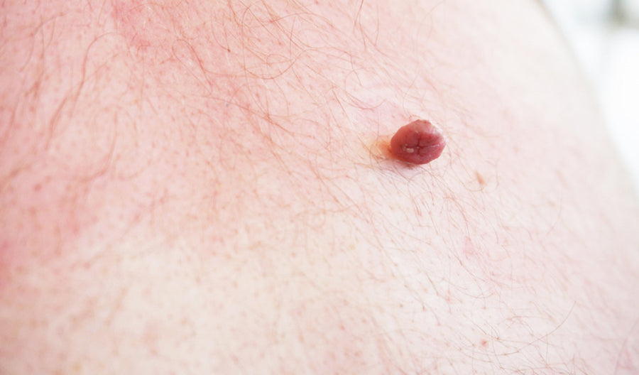 3 Safe Methods for Getting Rid of Skin Tags – Tiege Hanley