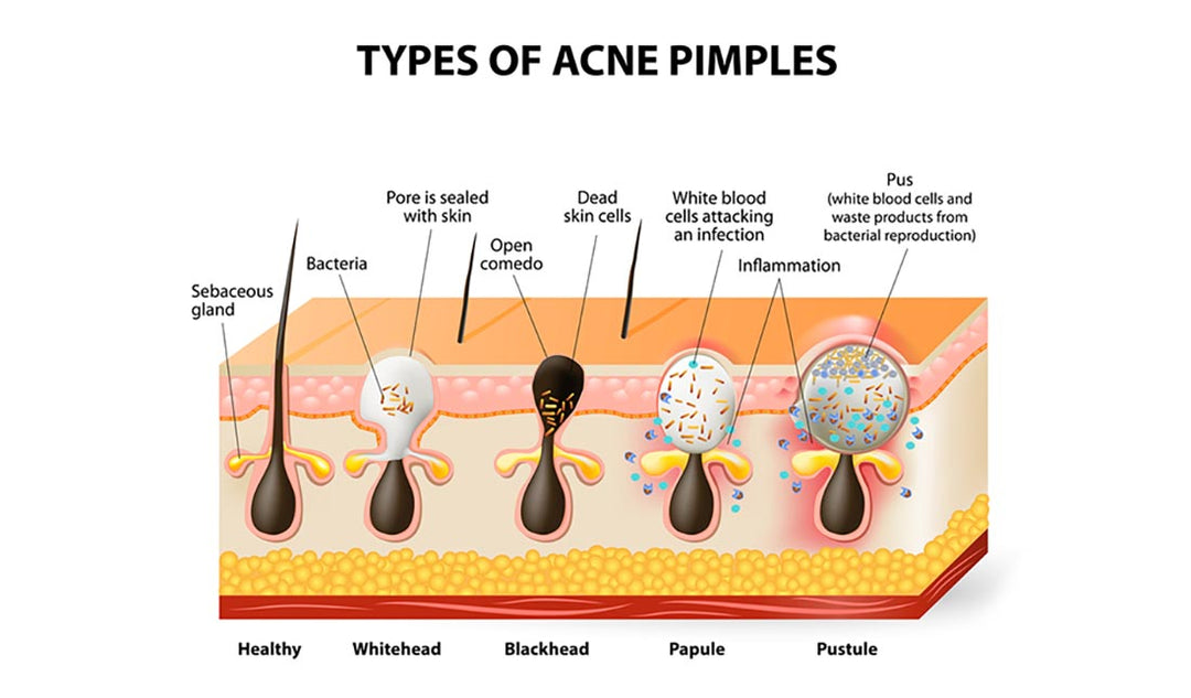 Acne vs. Zits vs. Pimples – What’s the Difference? – Tiege Hanley